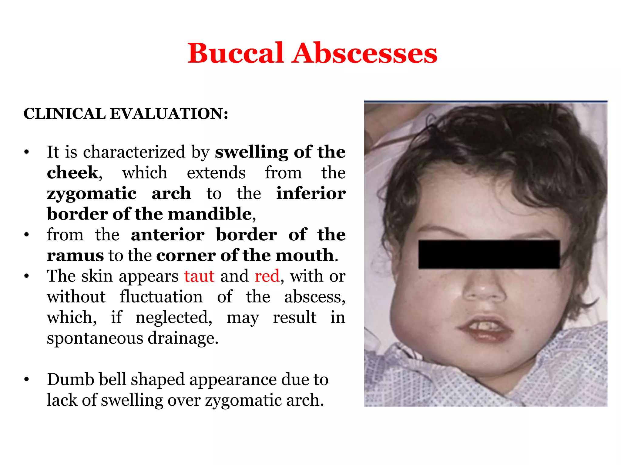Abscess oral maxillo-presentation | PPTX