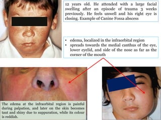 Abscess oral maxillo-presentation | PPTX