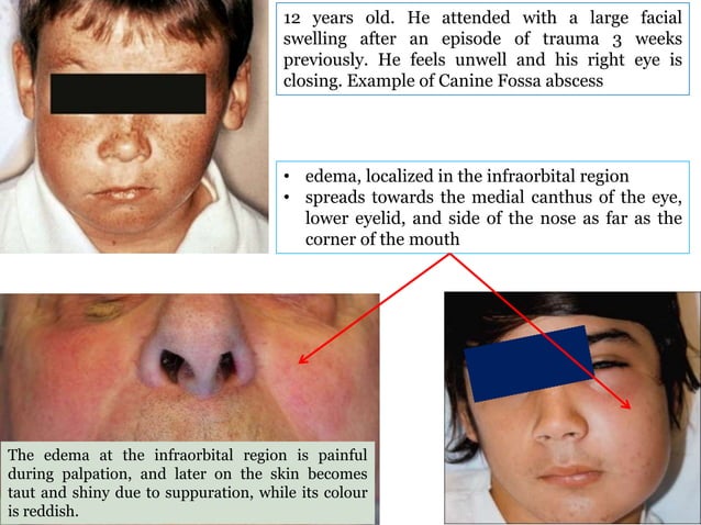 Abscess oral maxillo-presentation | PPTX