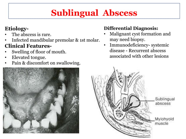 Abscess oral maxillo-presentation | PPTX
