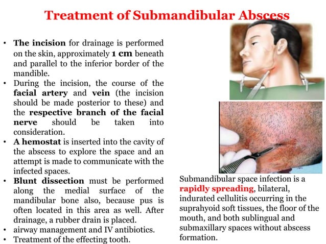 Abscess oral maxillo-presentation | PPTX