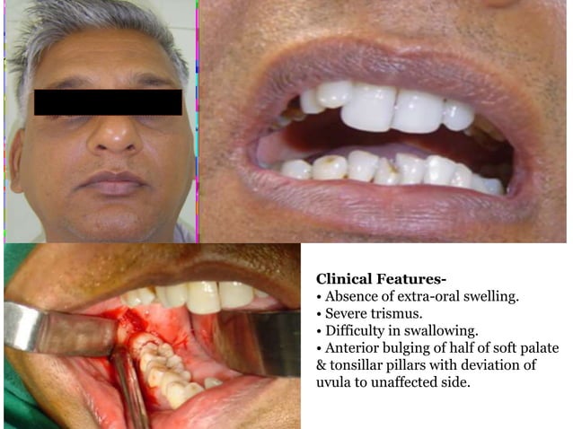 Abscess oral maxillo-presentation | PPTX