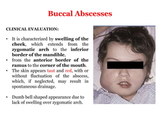 Abscess oral maxillo-presentation | PPTX