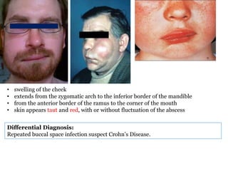 Abscess oral maxillo-presentation | PPTX