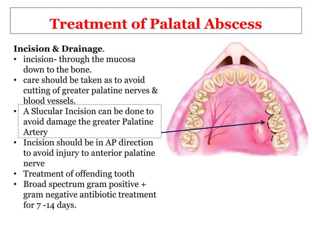 Abscess oral maxillo-presentation