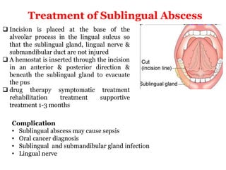 Sublingual Abscess