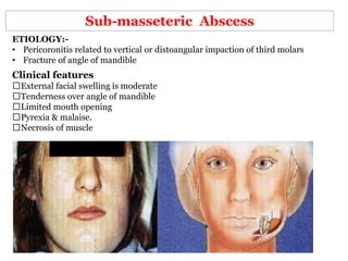 Abscess oral maxillo-presentation | PPT