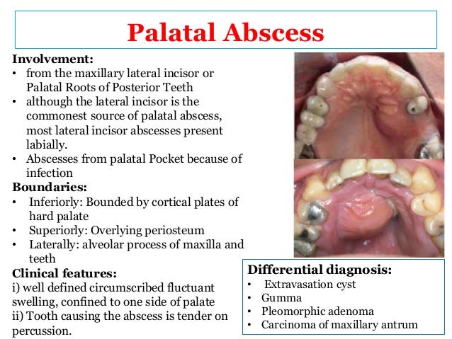 Abscess oral maxillo-presentation