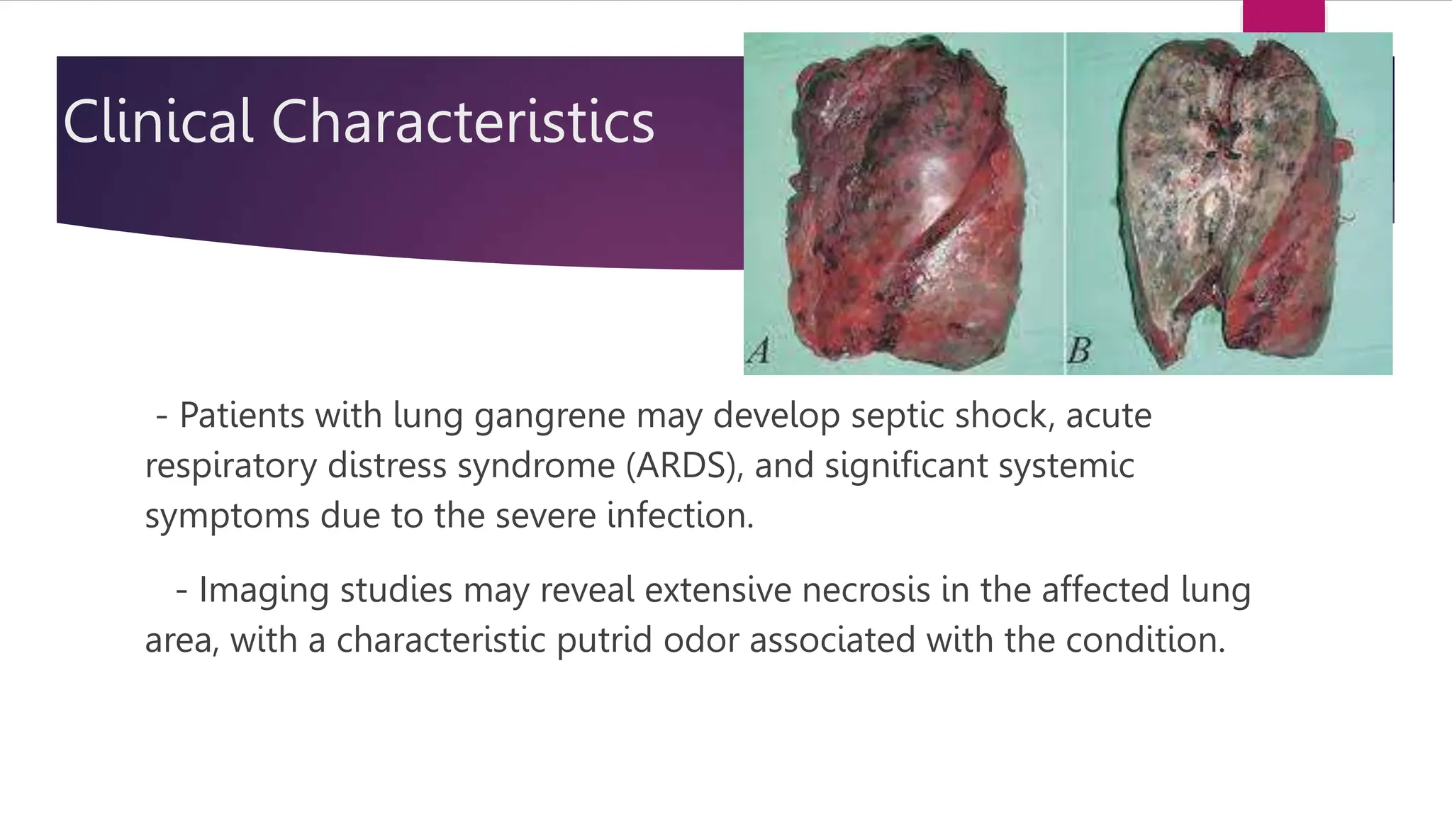 Abscess and Gangrene of the Lung: Understanding and Managing Pulmonary ...