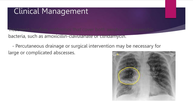 Abscess and Gangrene of the Lung: Understanding and Managing Pulmonary ...