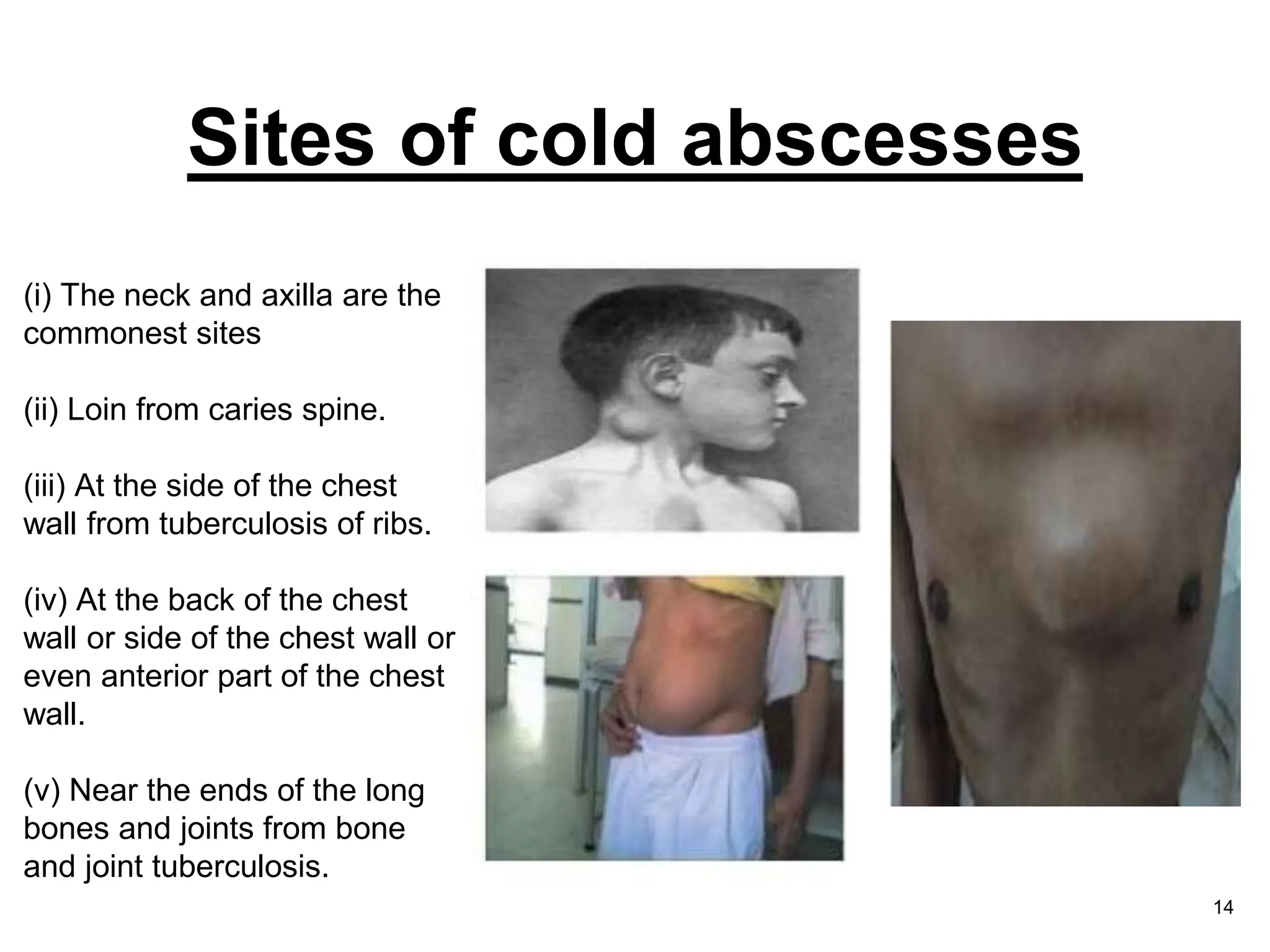 Abscess and its types, treatment . SINUS and its types | PPTX