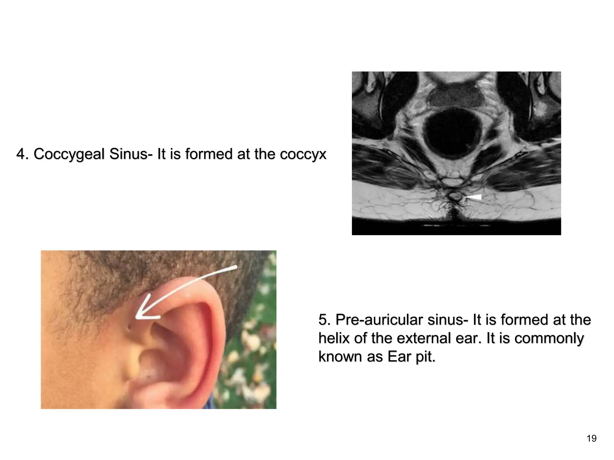 Abscess and its types, treatment . SINUS and its types | PPTX