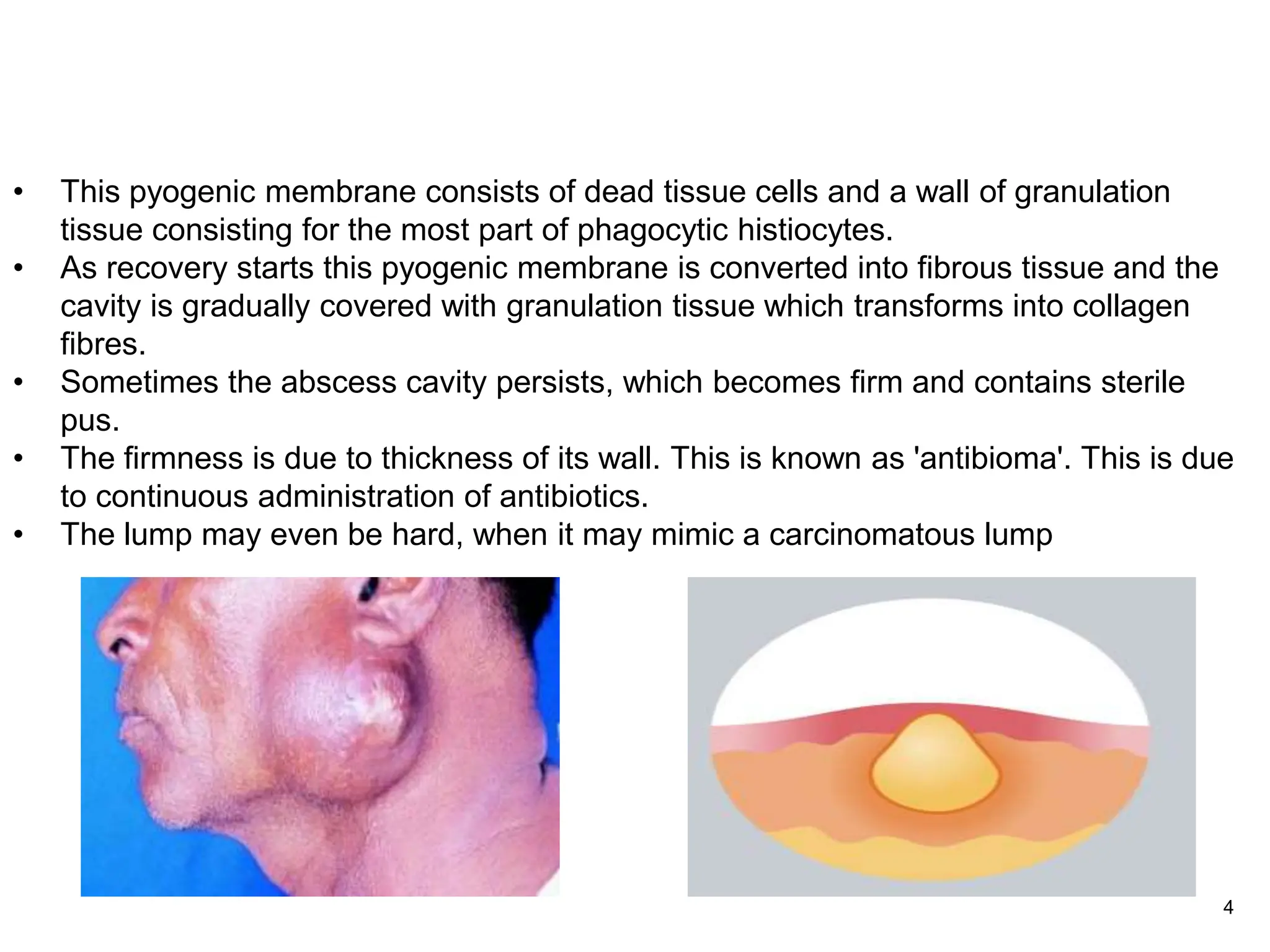 Abscess and its types, treatment . SINUS and its types | PPT
