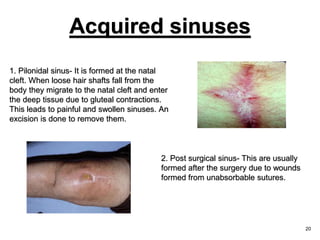Abscess and its types, treatment . SINUS and its types | PPT