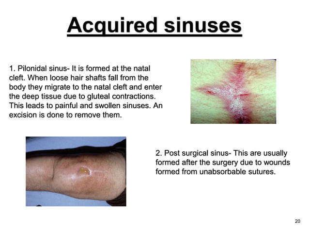 Abscess and its types, treatment . SINUS and its types | PPT
