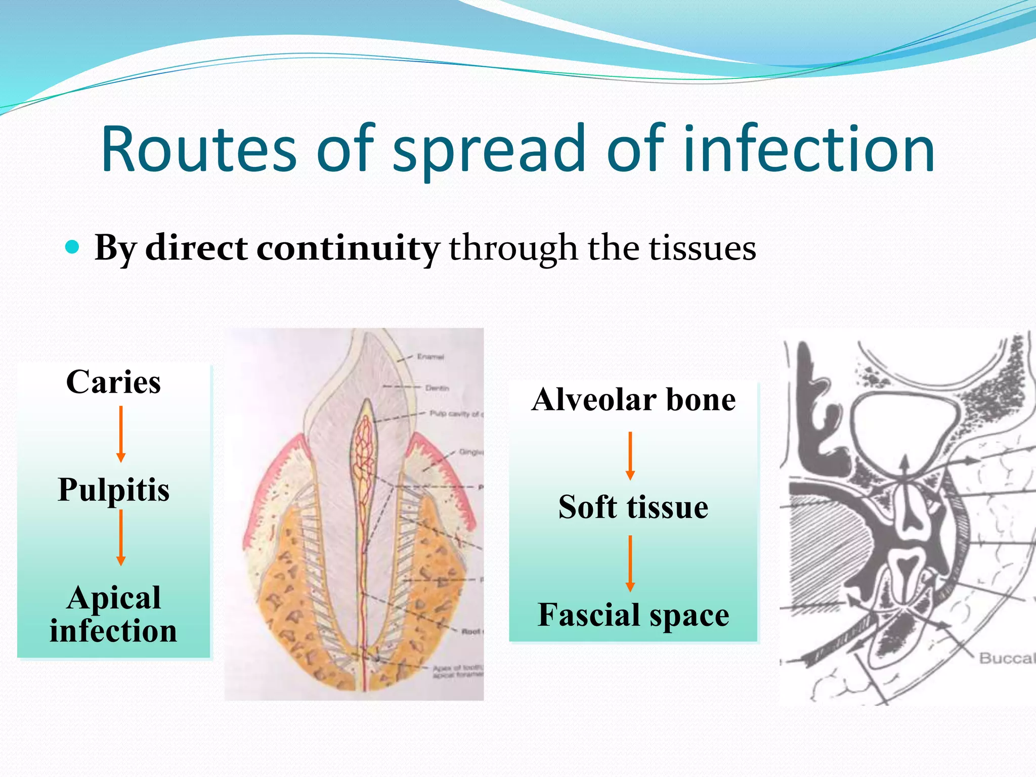 Abscess and phlegmon in maxillofacial region odontogenic infections- | PPSX