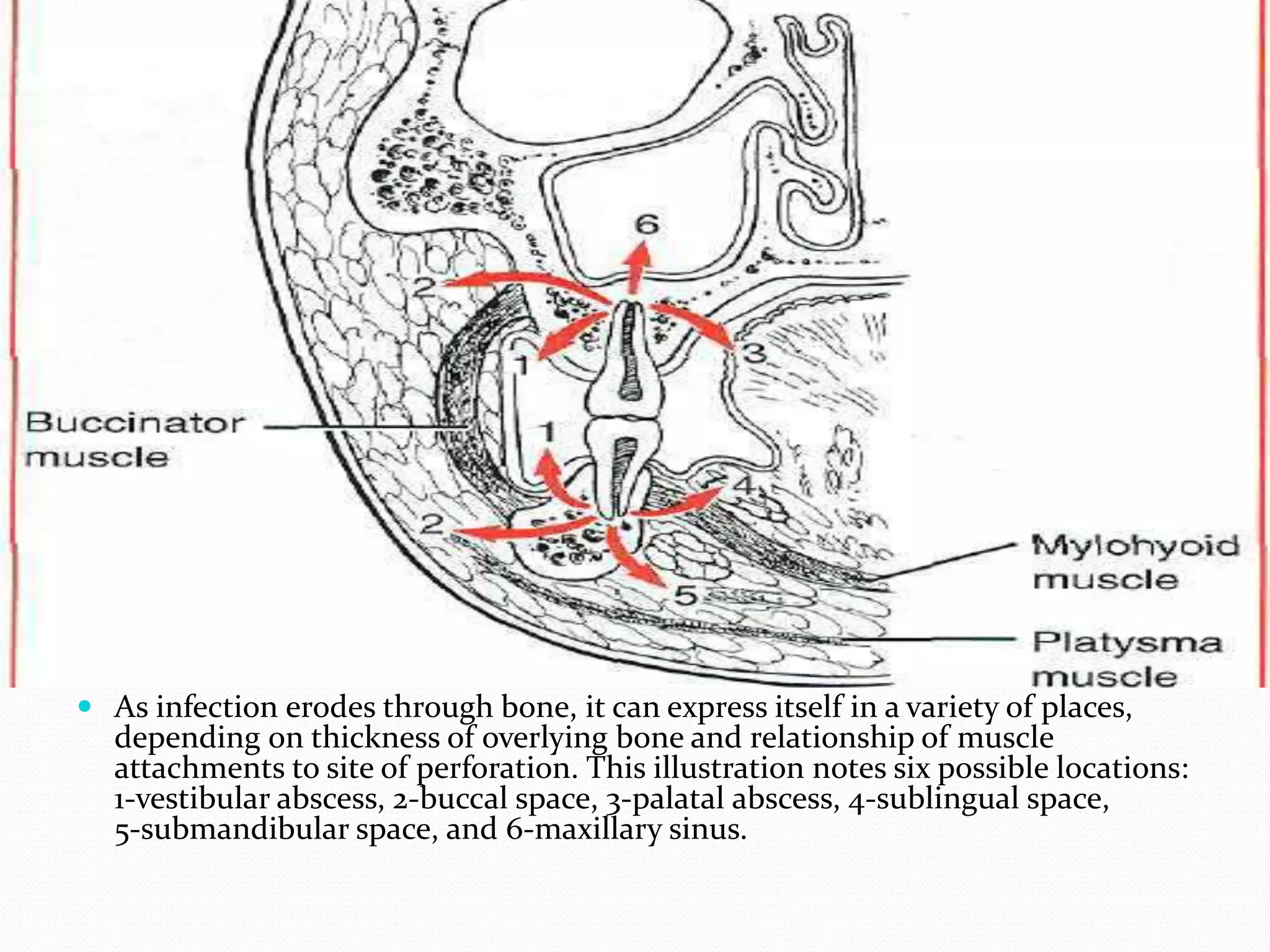 Abscess and phlegmon in maxillofacial region odontogenic infections- | PPSX