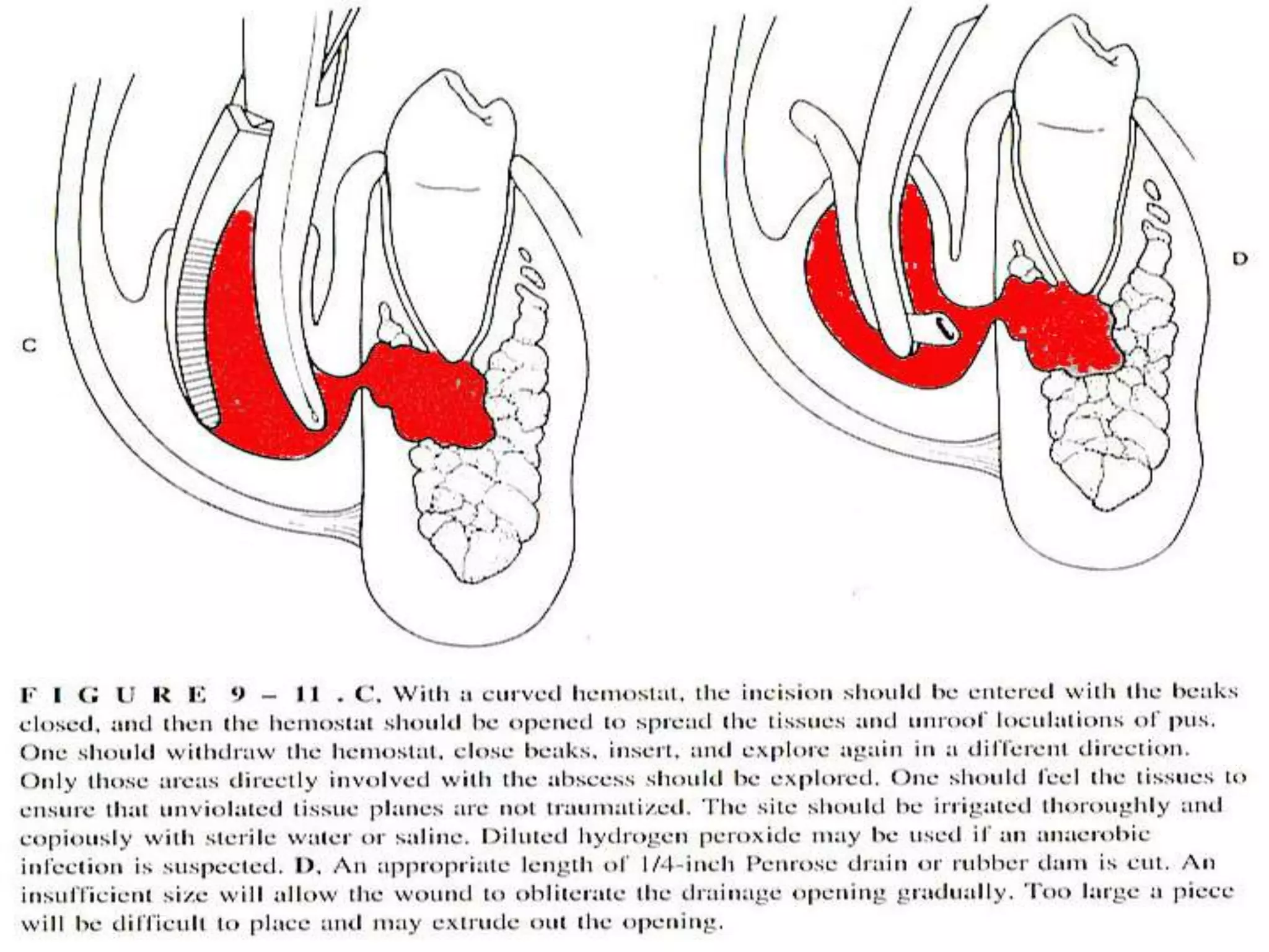 Abscess and phlegmon in maxillofacial region odontogenic infections- | PPSX