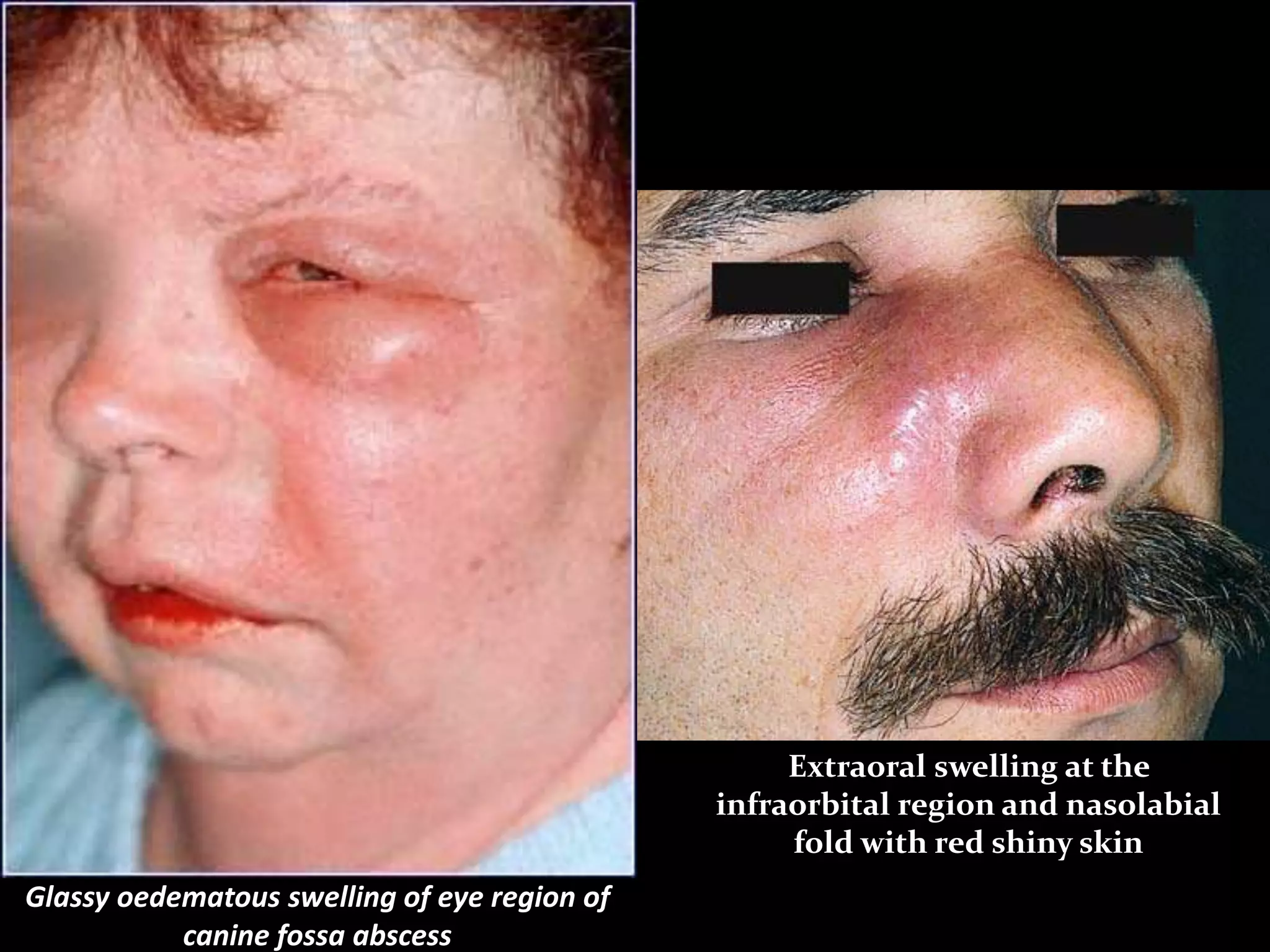 Abscess and phlegmon in maxillofacial region odontogenic infections- | PPSX