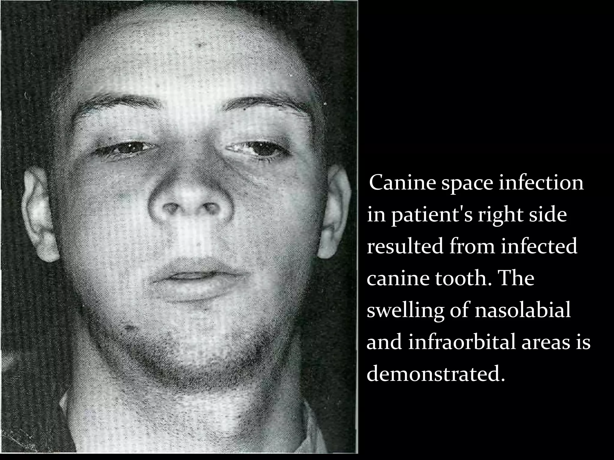Abscess and phlegmon in maxillofacial region odontogenic infections- | PPSX