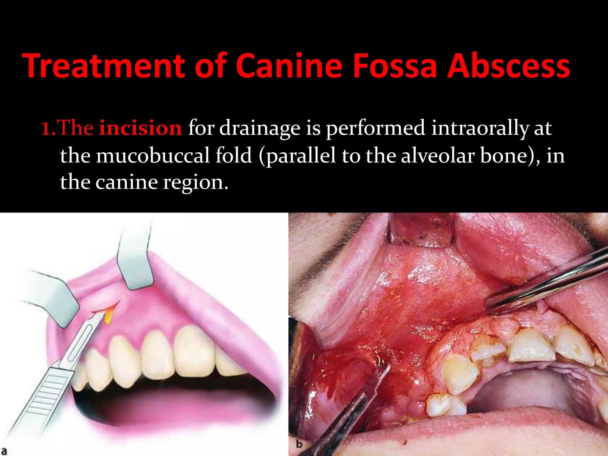 Abscess and phlegmon in maxillofacial region odontogenic infections- | PPSX
