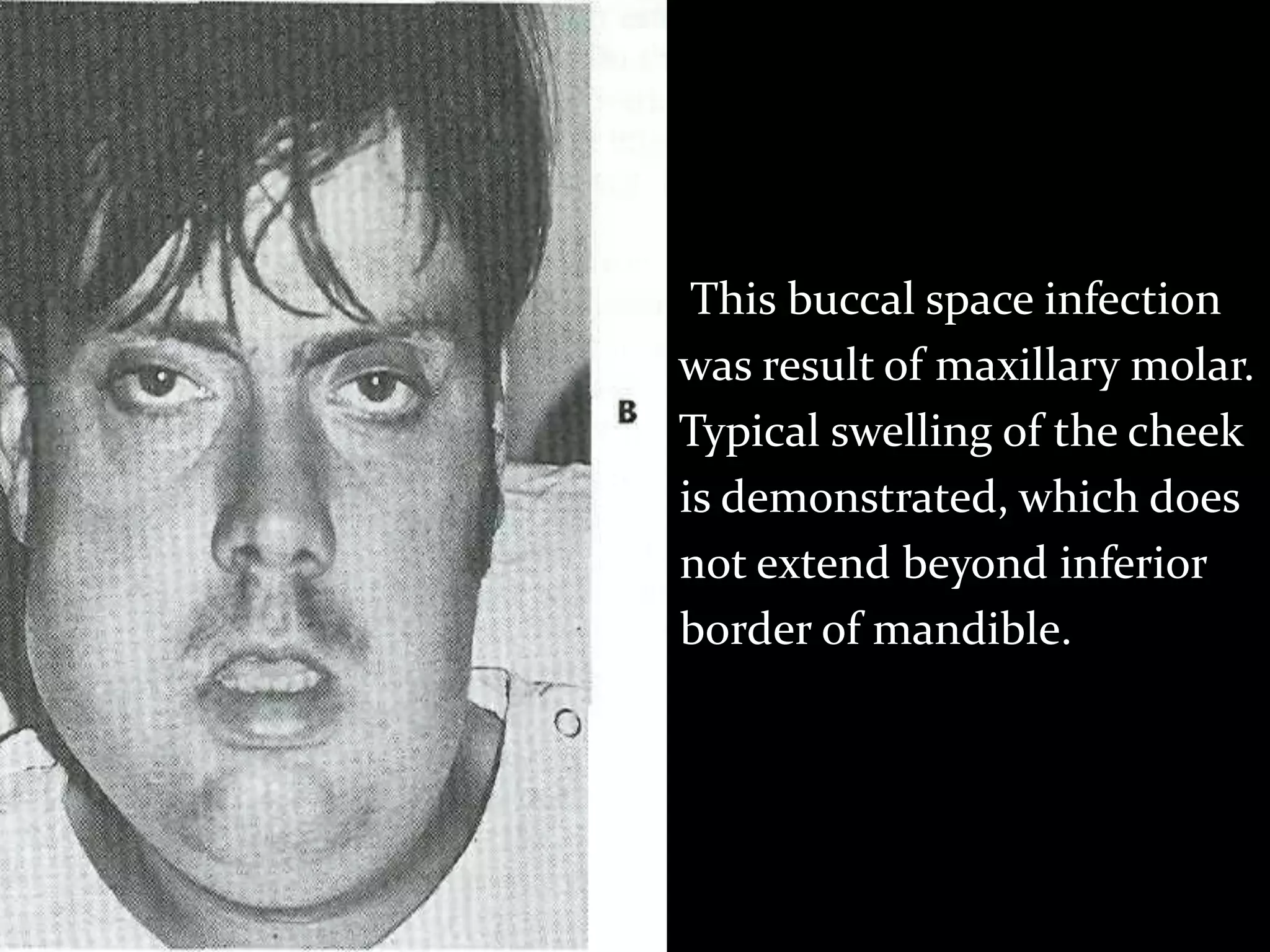 Abscess and phlegmon in maxillofacial region odontogenic infections- | PPSX