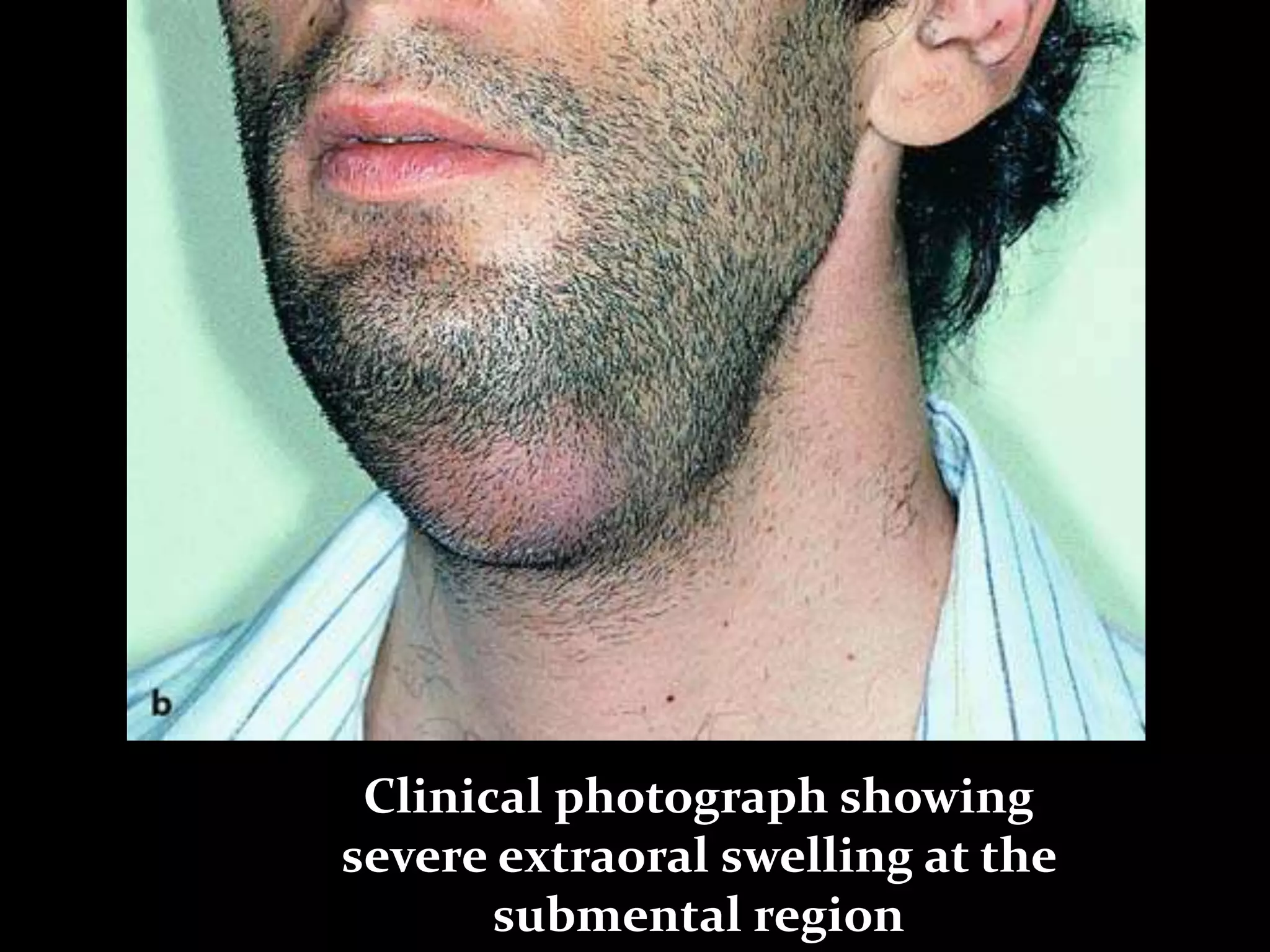 Abscess and phlegmon in maxillofacial region odontogenic infections- | PPSX