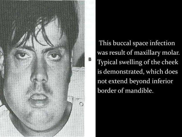 Abscess and phlegmon in maxillofacial region odontogenic infections- | PPSX