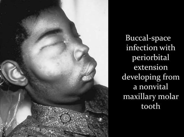 Abscess and phlegmon in maxillofacial region odontogenic infections- | PPSX