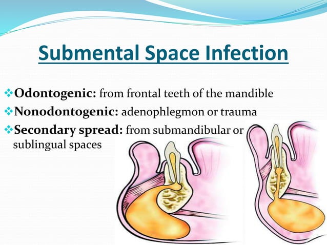Abscess and phlegmon in maxillofacial region odontogenic infections- | PPSX