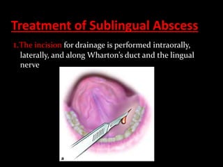 Abscess and phlegmon in maxillofacial region odontogenic infections- | PPSX