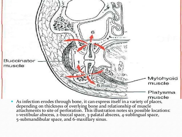 Abscess and phlegmon in maxillofacial region odontogenic infections-