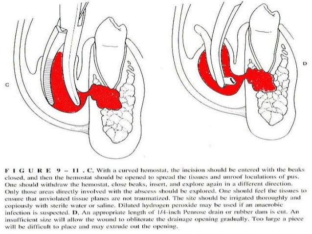 Abscess and phlegmon in maxillofacial region odontogenic infections-