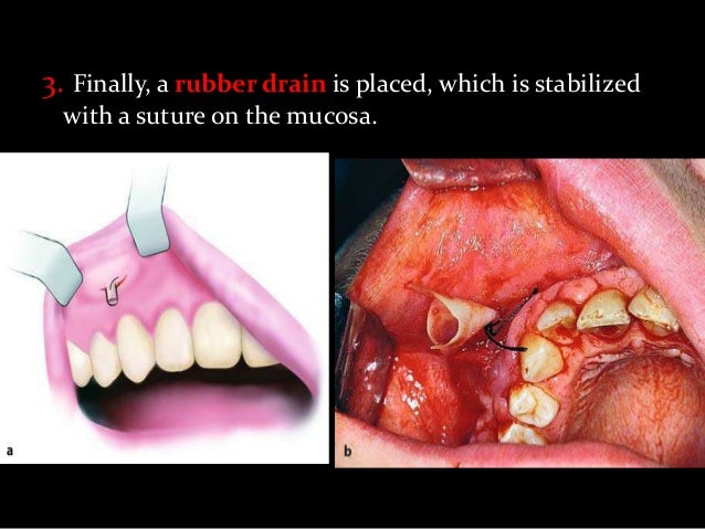 Abscess and phlegmon in maxillofacial region odontogenic infections-