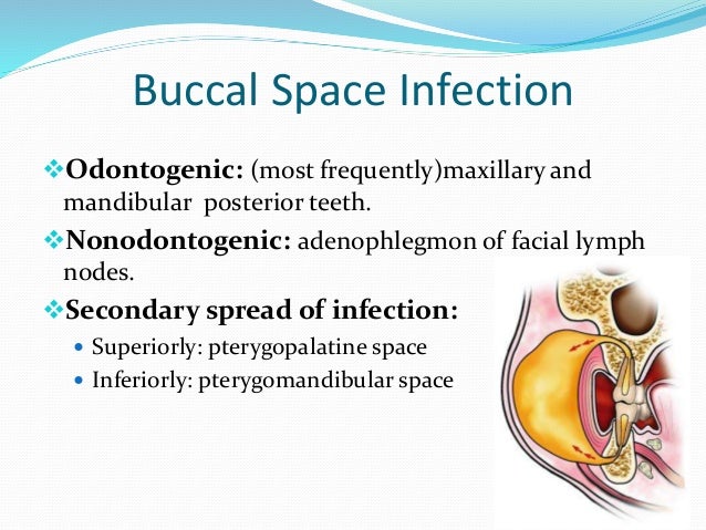 Abscess and phlegmon in maxillofacial region odontogenic infections-