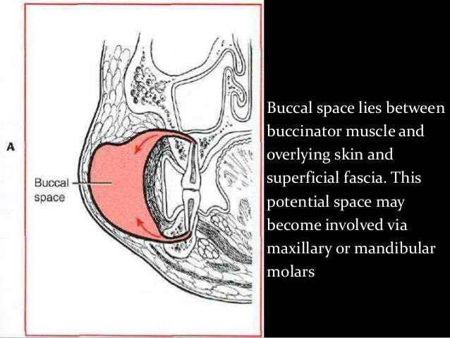 Abscess and phlegmon in maxillofacial region odontogenic infections-