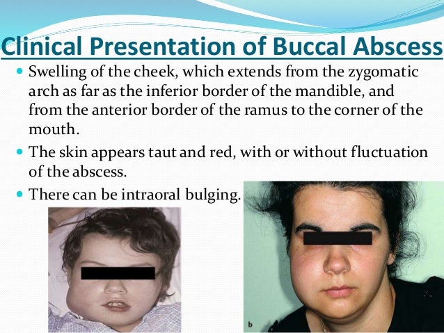 Abscess and phlegmon in maxillofacial region odontogenic infections-