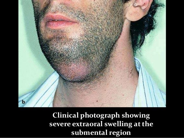 Abscess and phlegmon in maxillofacial region odontogenic infections-