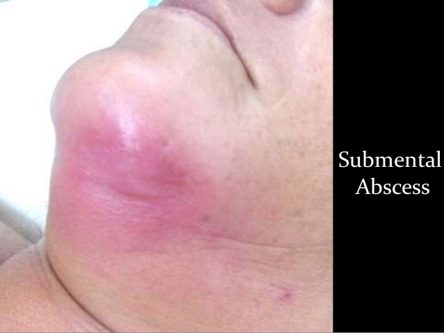 Abscess and phlegmon in maxillofacial region odontogenic infections-