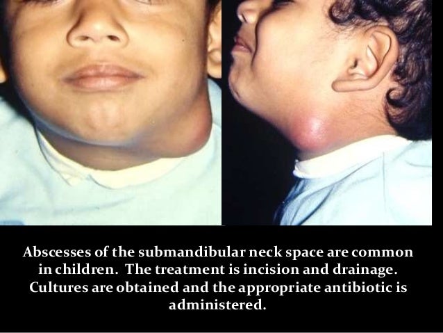 Abscess and phlegmon in maxillofacial region odontogenic infections-