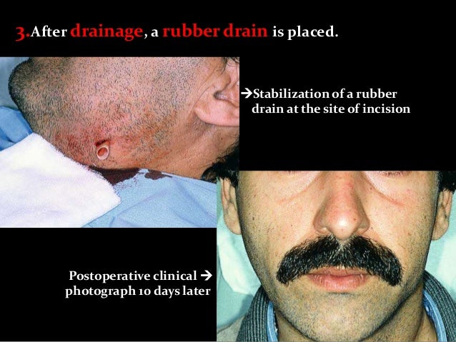 Abscess And Phlegmon In Maxillofacial Region Odontogenic Infections