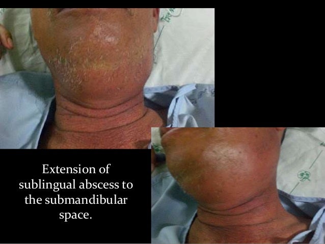 Abscess and phlegmon in maxillofacial region odontogenic infections-