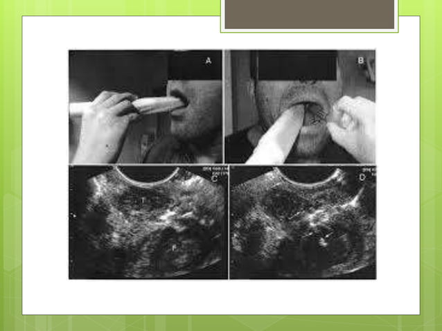 Abscesses of pharynx | PPTX | Ear, Nose and Throat Conditions ...