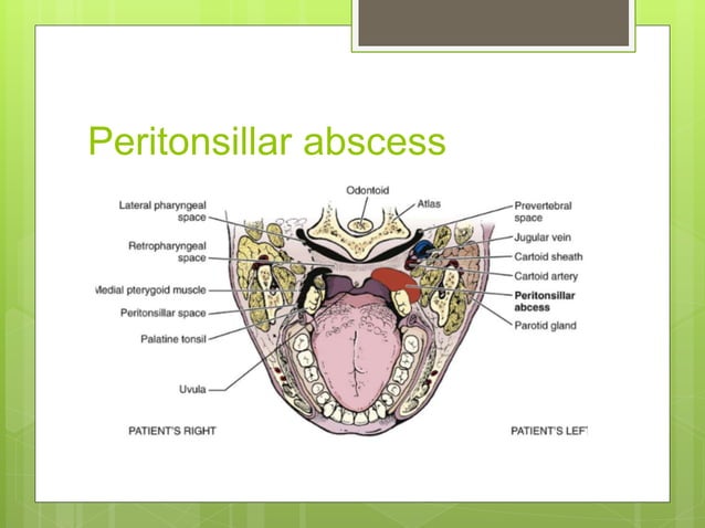 Abscesses of pharynx | PPTX | Ear, Nose and Throat Conditions ...