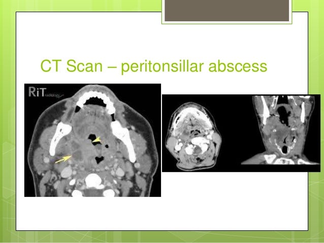 Abscesses of pharynx