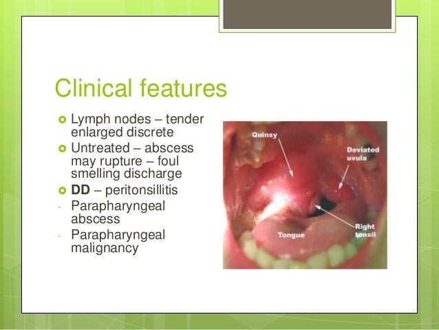 Abscesses of pharynx