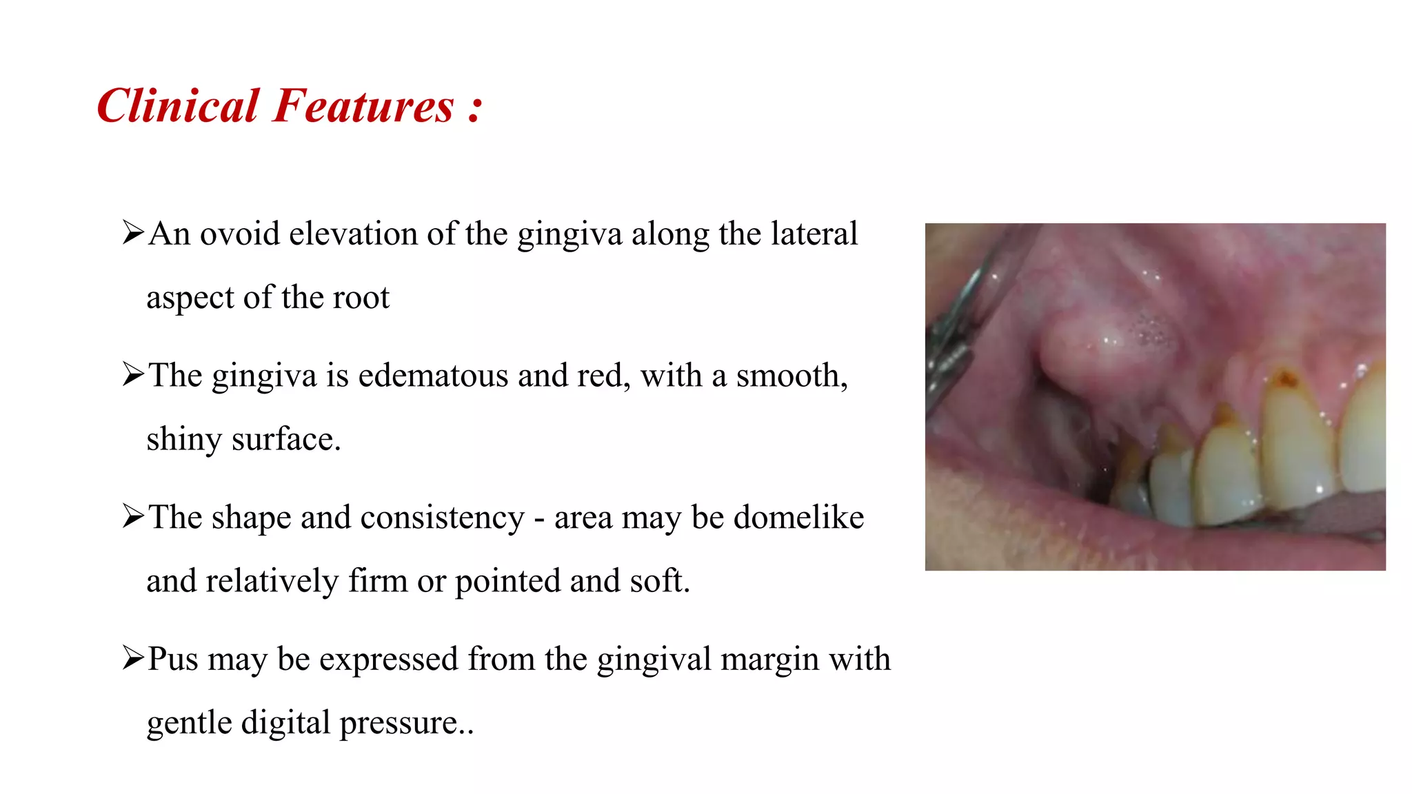 Abscesses of the periodontium | PPT