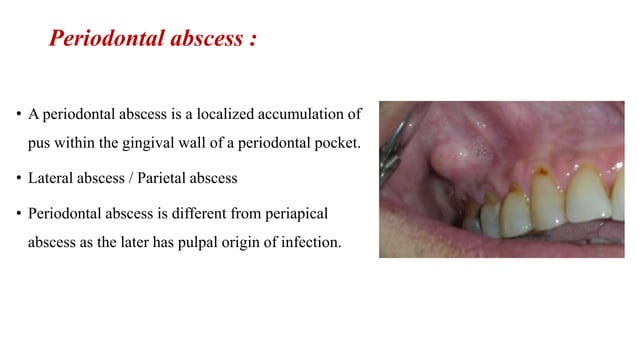Abscesses of the periodontium | PPT