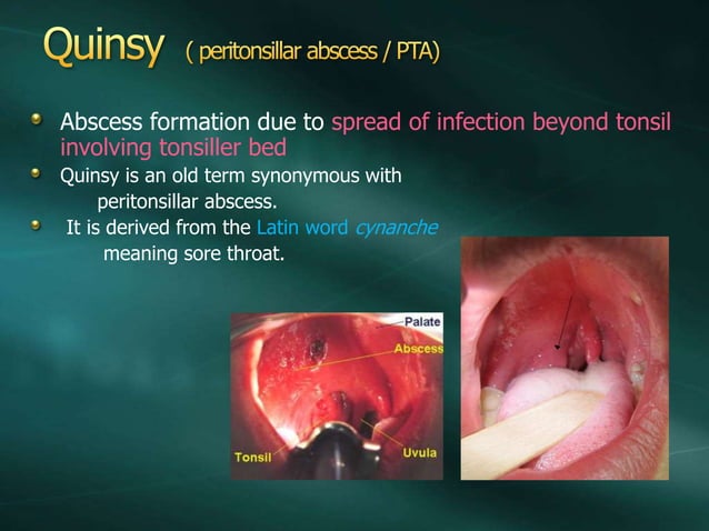 Abscess | PPTX | Ear, Nose and Throat Conditions | Diseases and Conditions