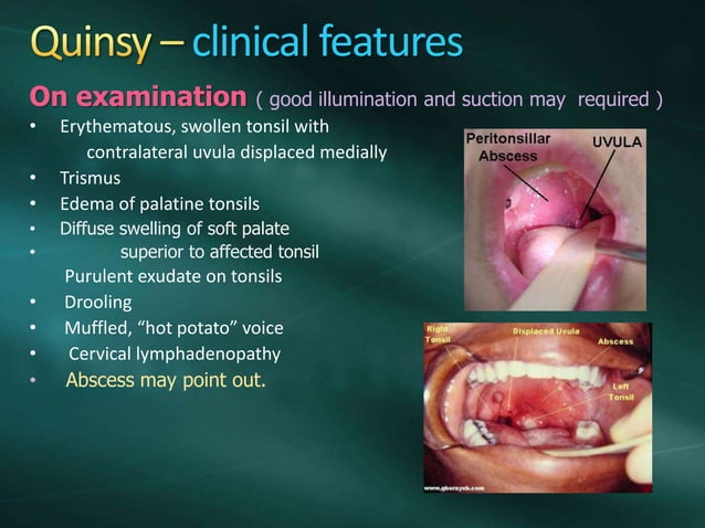 Abscess | PPTX | Ear, Nose and Throat Conditions | Diseases and Conditions